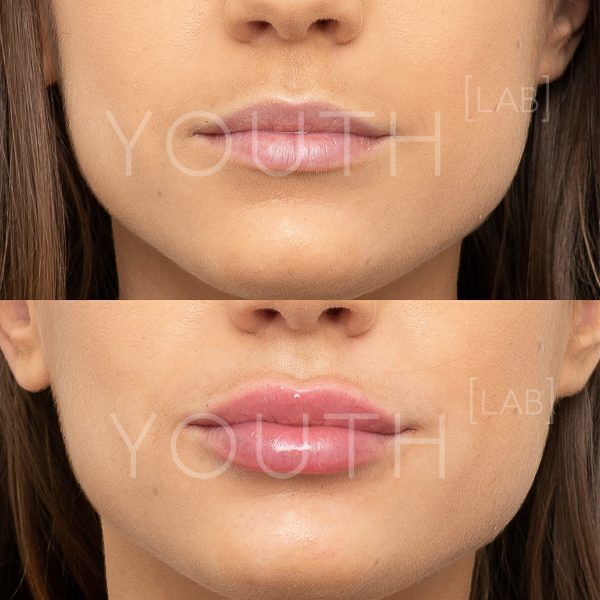 What Does The Perfect Lip Look Like In 2019?